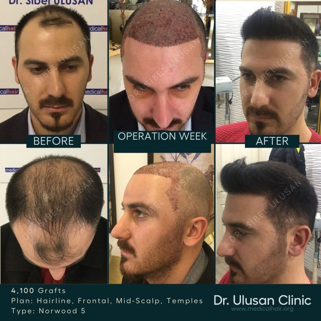 What Does the Hamilton-Norwood Scale Tell Us About Hair Loss? - Dr ...